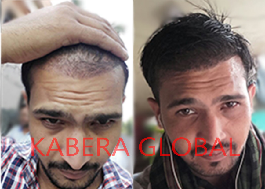 Kabera - Kabera Global